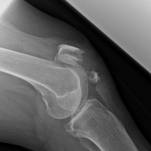 Cirugía de rodilla en guadalajara